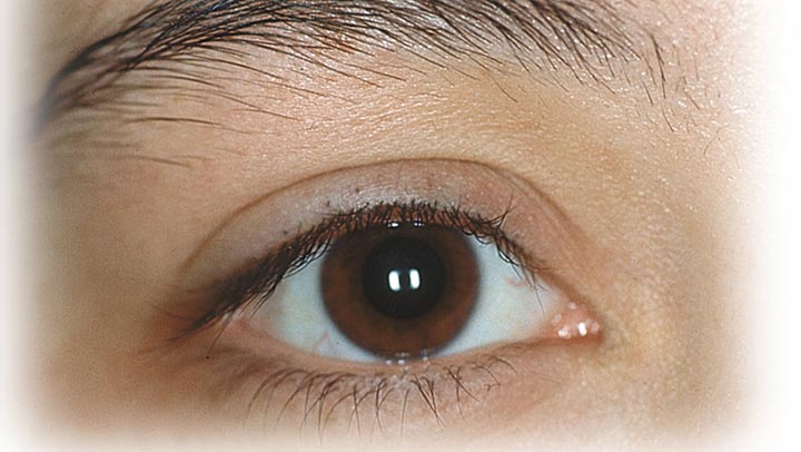Twitches or Spasms | South Bay Ophthalmology
