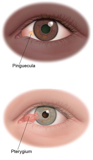 Pinguecula and Pterygium | South Bay Ophthalmology