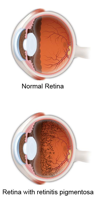 Retinitis Pigmentosa | South Bay Ophthalmology
