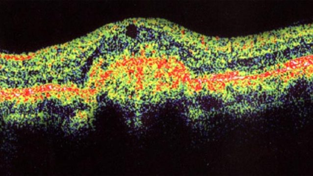Optical Coherence Tomography OCT – Retina & Optic Nerve Scan | South ...