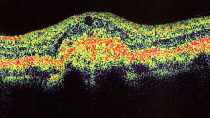 Optical Coherence Tomography OCT – Retina & Optic Nerve Scan | South ...