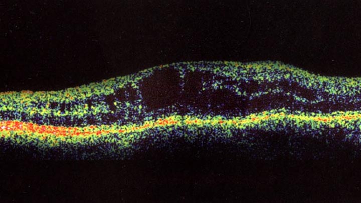 Optical Coherence Tomography OCT – Retina & Optic Nerve Scan | South ...
